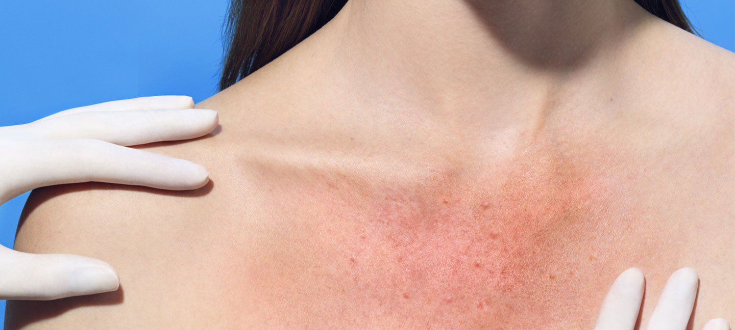 Protección solar para piel reactiva al sol | La Roche-Posay